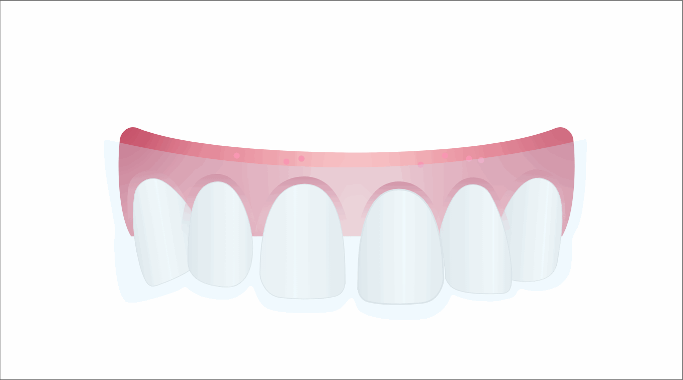 Invisalign® – Dentist in London | Wytes London